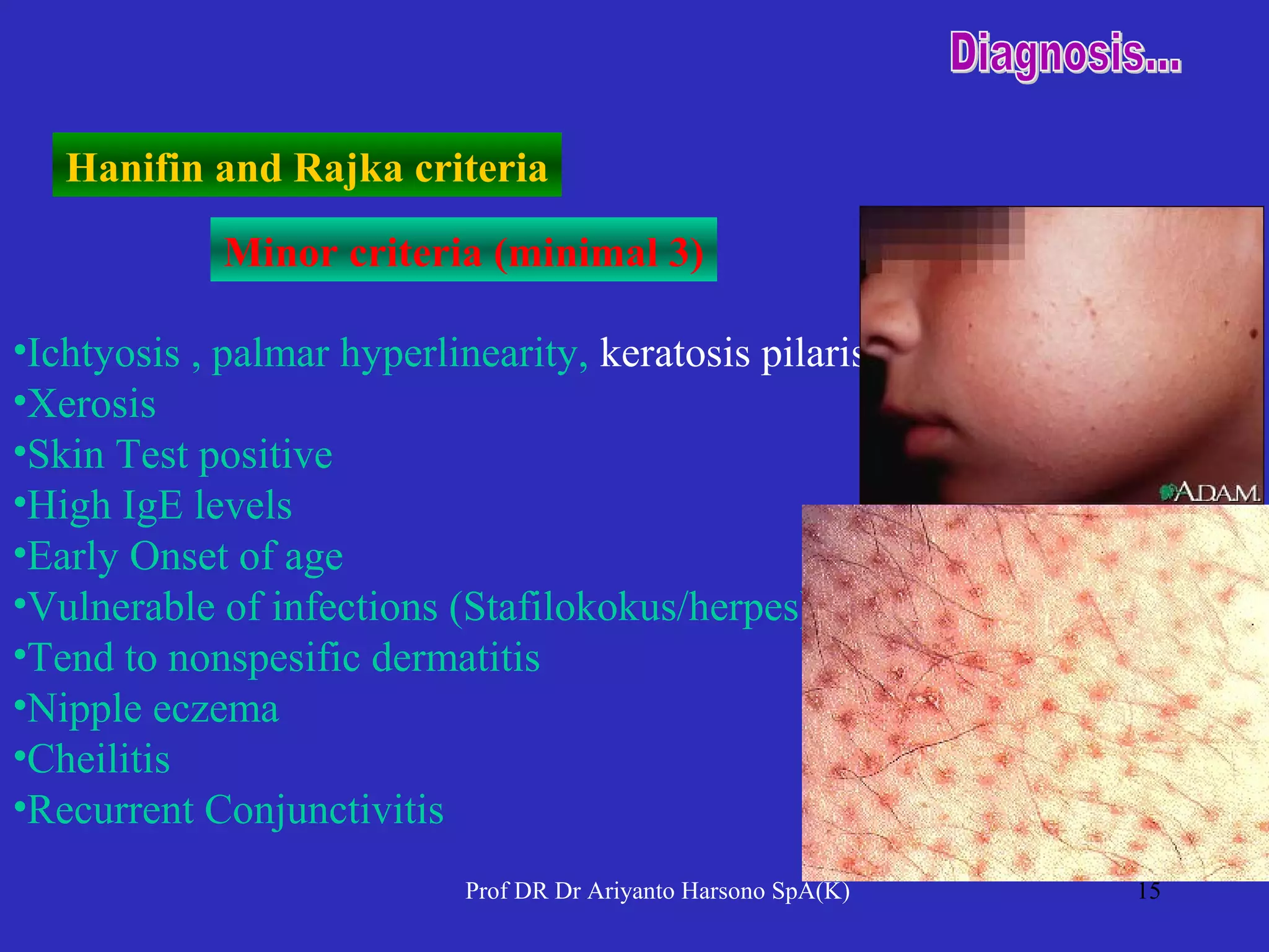Penanganan Dermatitis Atopik | PPT