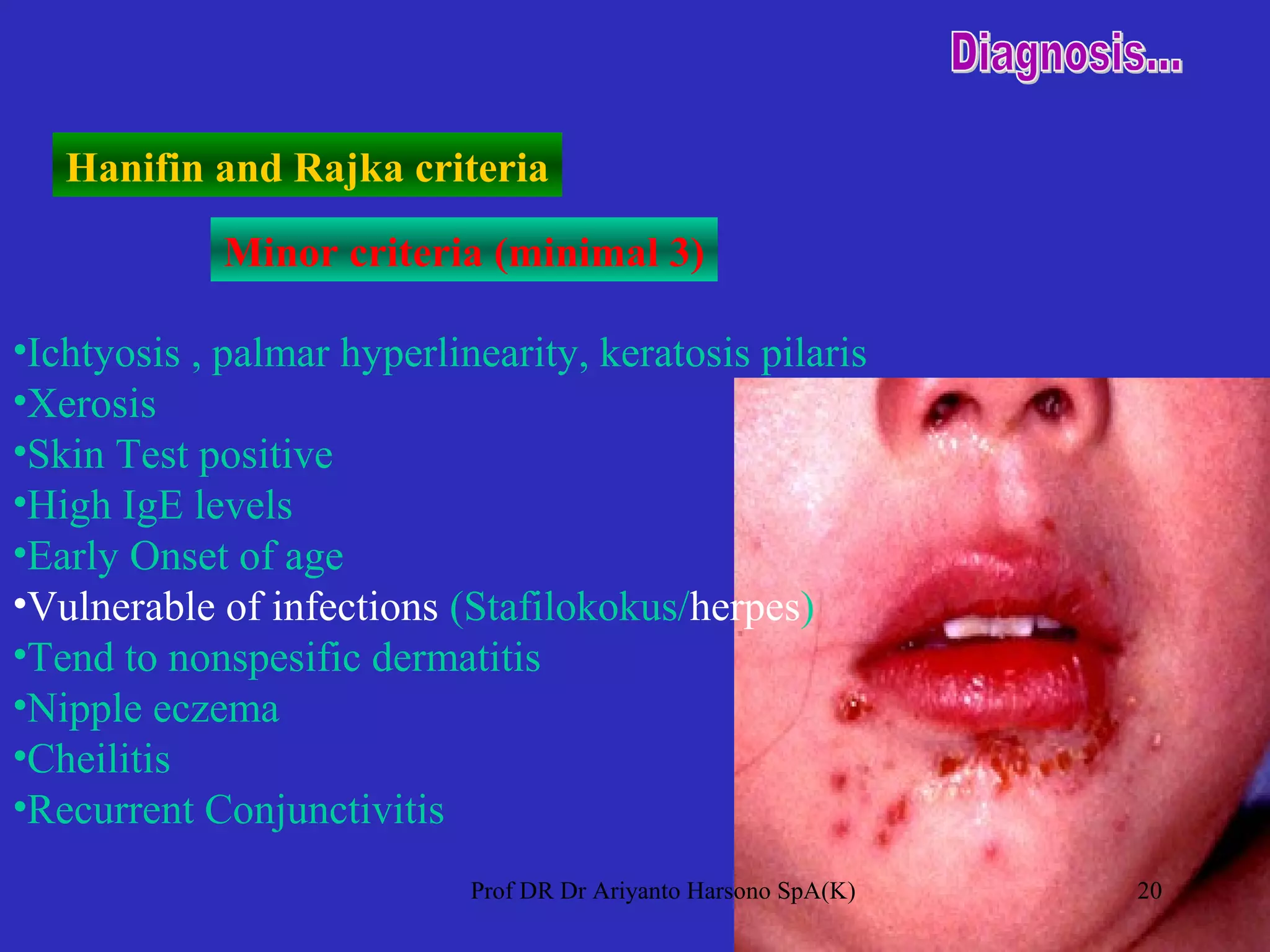 Penanganan Dermatitis Atopik | PPT