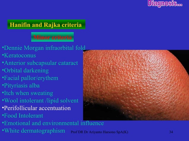 Penanganan Dermatitis Atopik | PPT