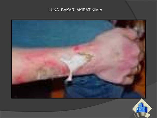 Penanganan luka bakar | PPT