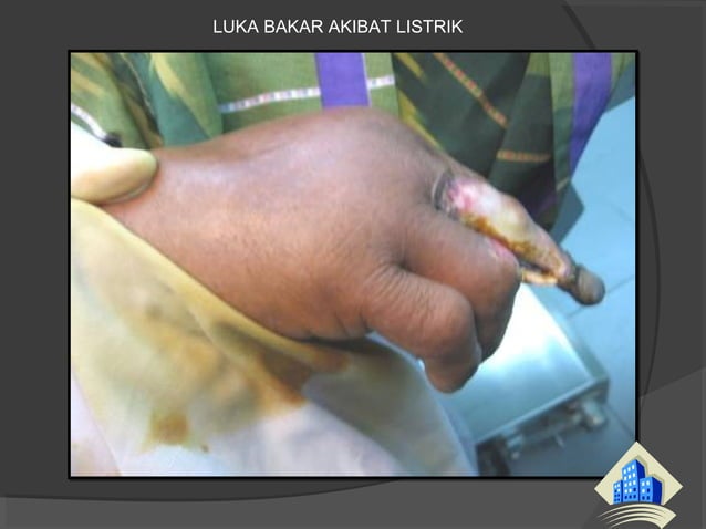 Penanganan luka bakar | PPT