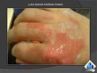 Penanganan luka bakar | PPT