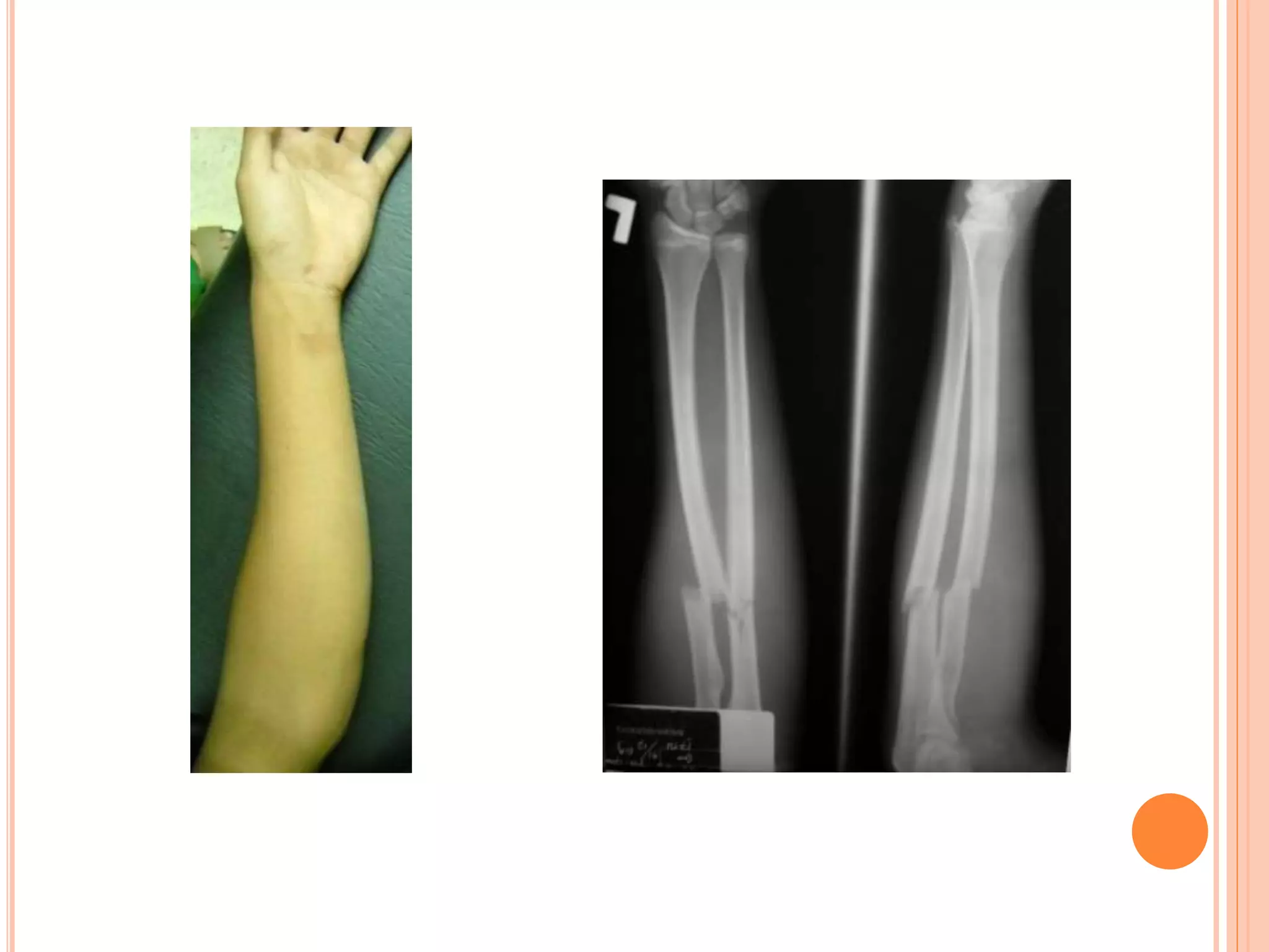 Penanganan terkini patah tulang terbuka (open fracture) | PPTX