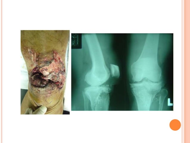 Penanganan terkini patah tulang terbuka (open fracture) | PPTX