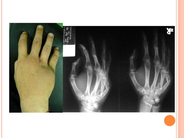 Penanganan terkini patah tulang terbuka (open fracture) | PPTX