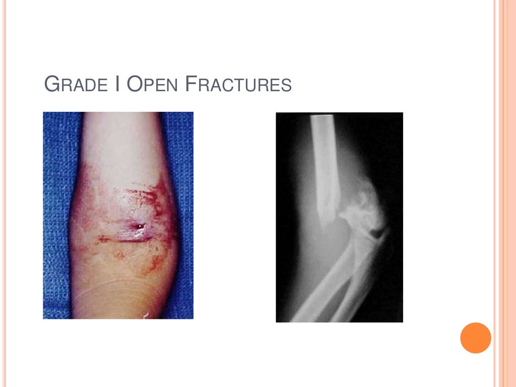 Penanganan terkini patah tulang terbuka (open fracture)