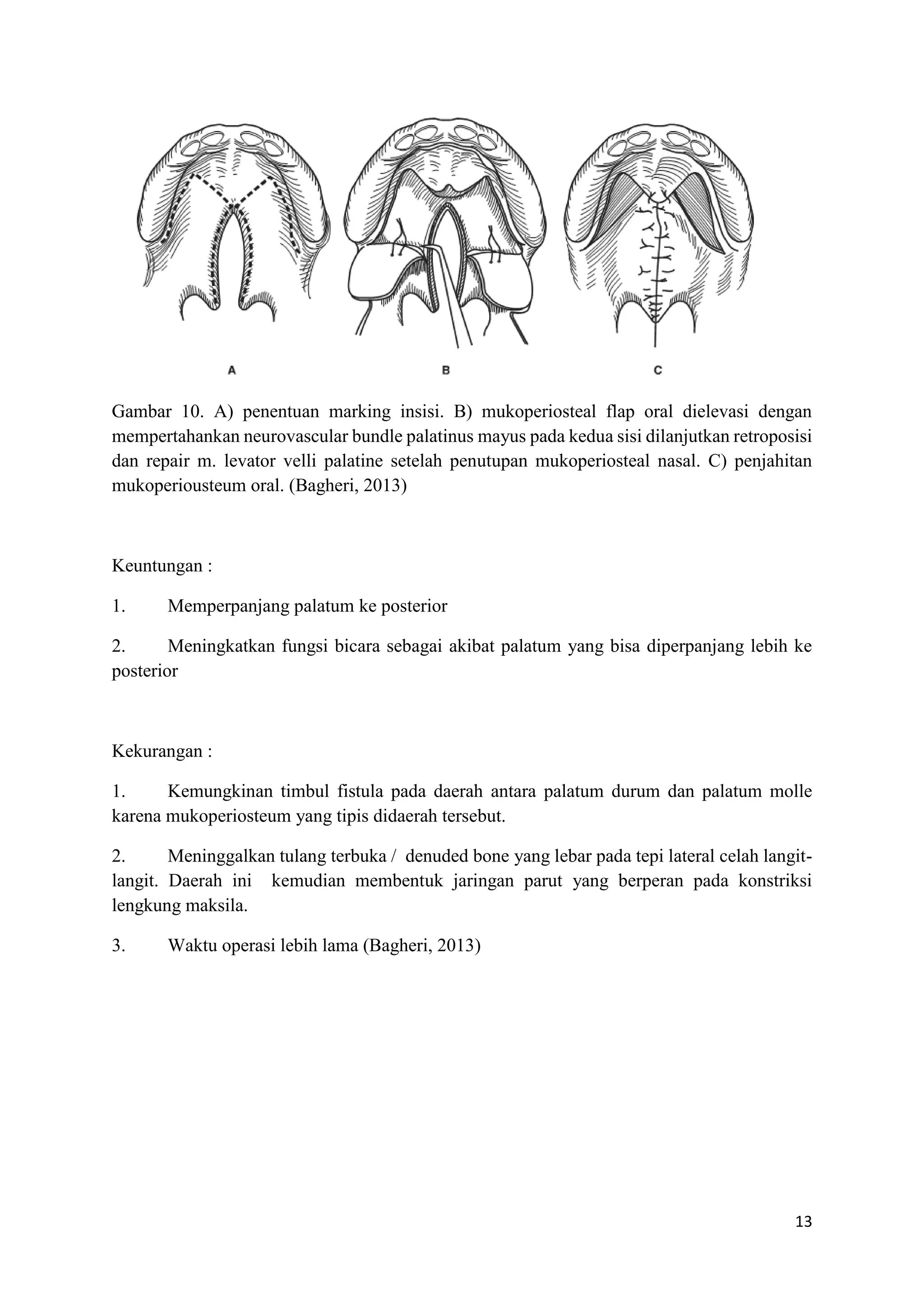 Penatalaksanaan cleft lip palate sumbing aai | PDF