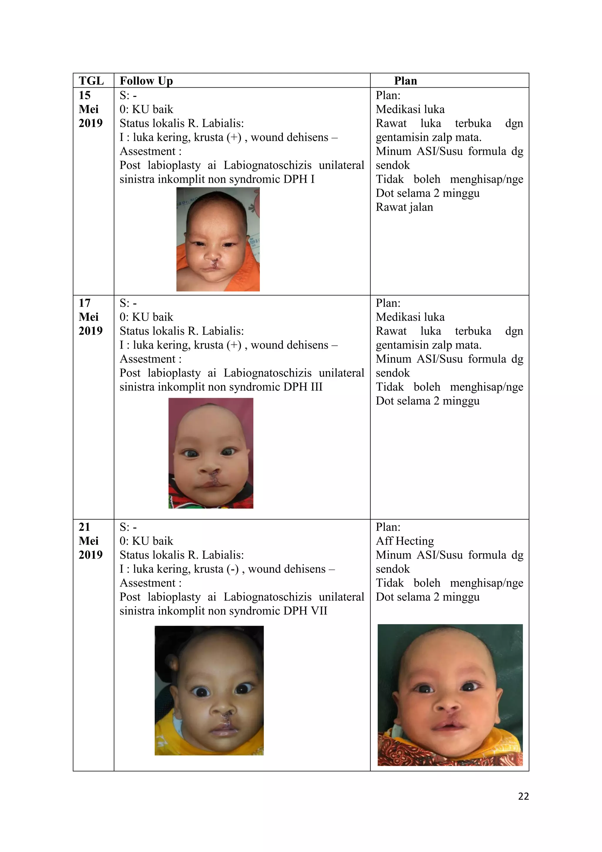 Penatalaksanaan cleft lip palate sumbing aai | PDF