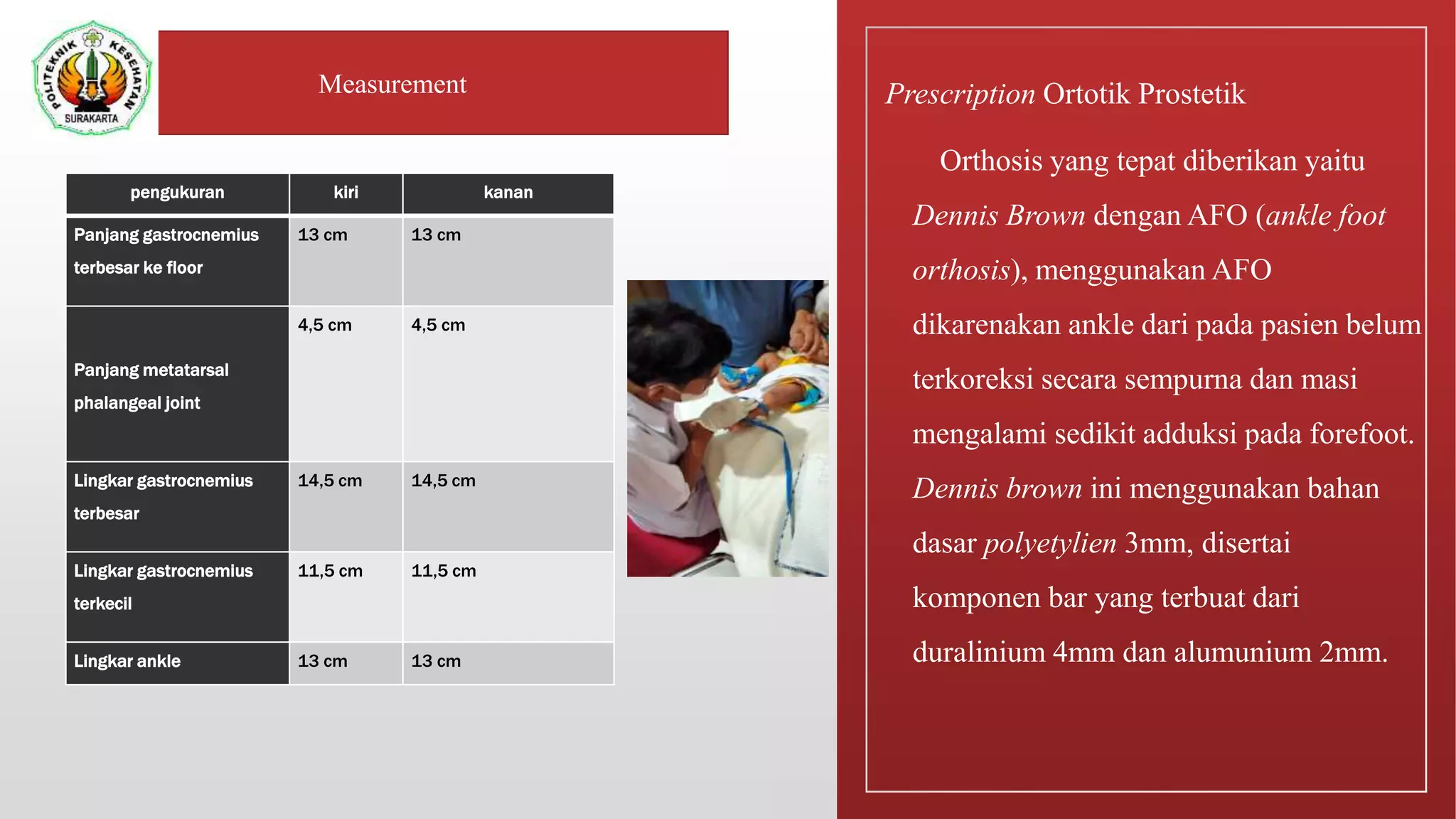 Penatalaksanaan pasien congenital talipes equinus varus bilateral ...