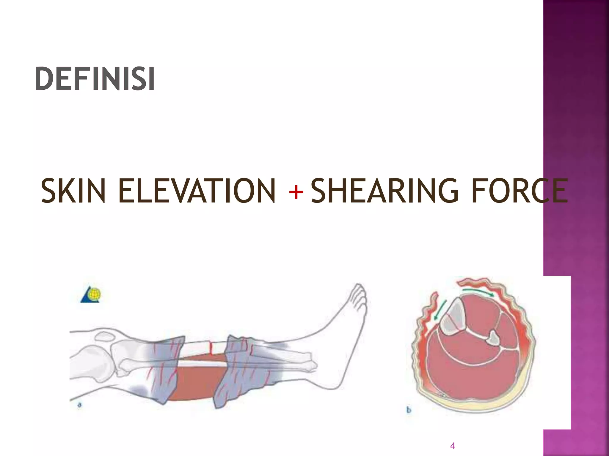 Penatalaksanaan vulnus degloving | PPT