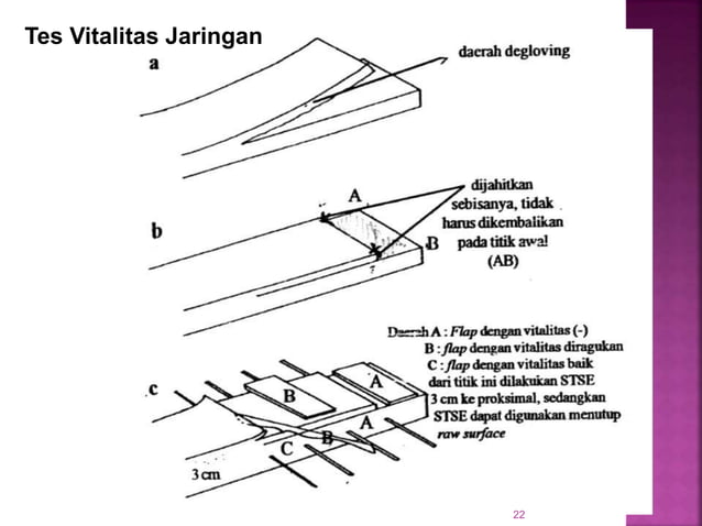 Penatalaksanaan vulnus degloving | PPT
