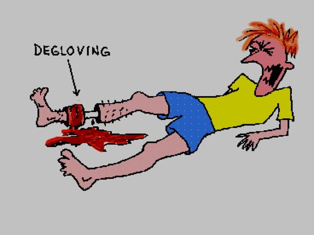 Penatalaksanaan vulnus degloving | PPT