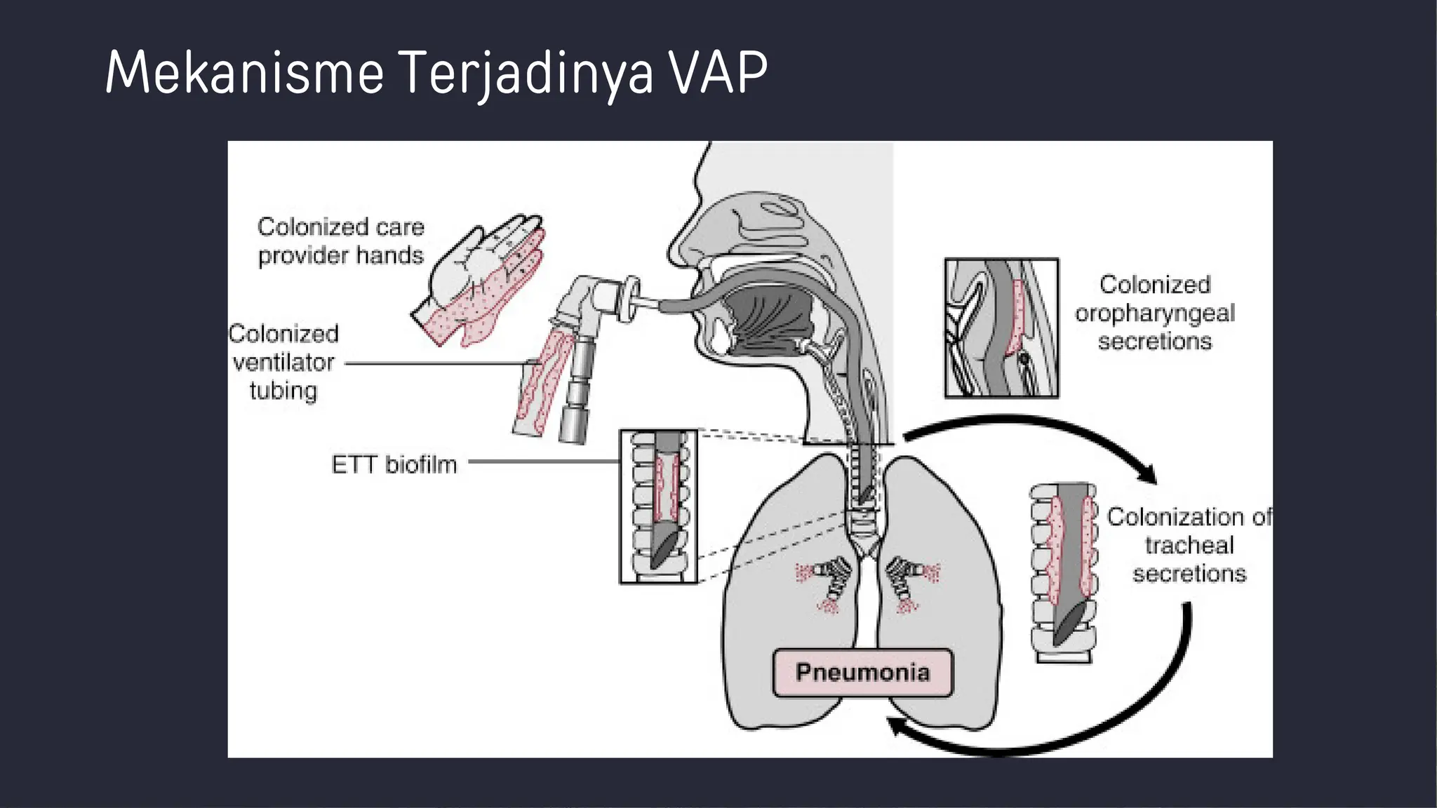 Pencegahan Dan Pengendalian Infeksi Dengan Penerapan Bundles Hais.pdf