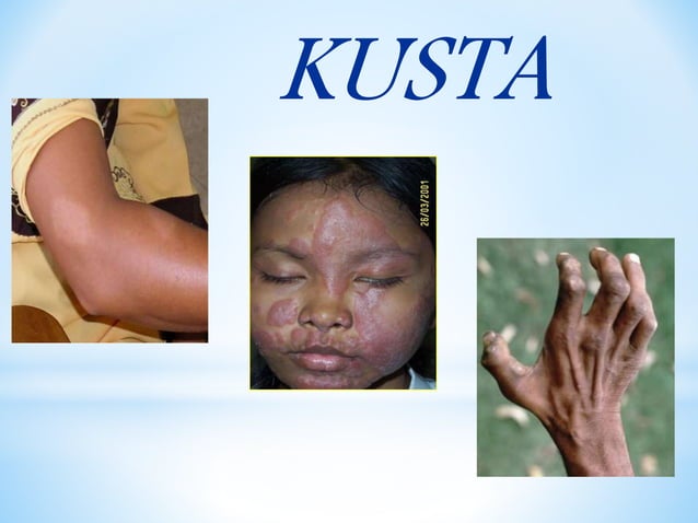 Pencegahan Disabilitas Dan Perawatan Diri Penderita Kusta.ppt