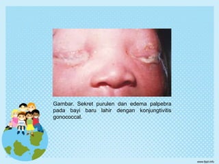 Pencegahan IMS Bayi.ppt