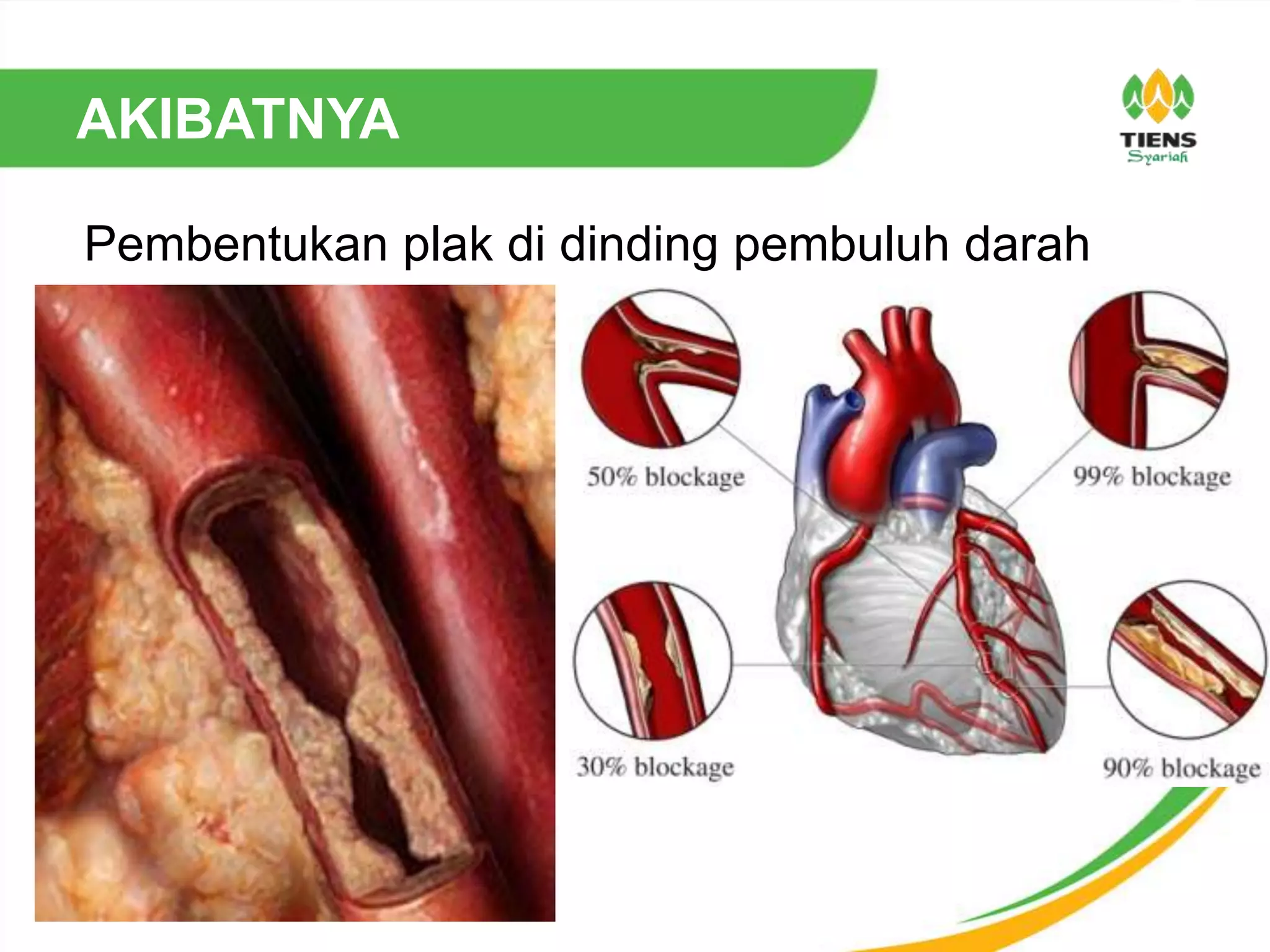 Pencegahan penyakit pembuluh darah jantung dengan terapi gizi TIENS | PPT