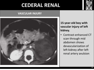 Pencitraan trauma abdomen pada anak | PPTX