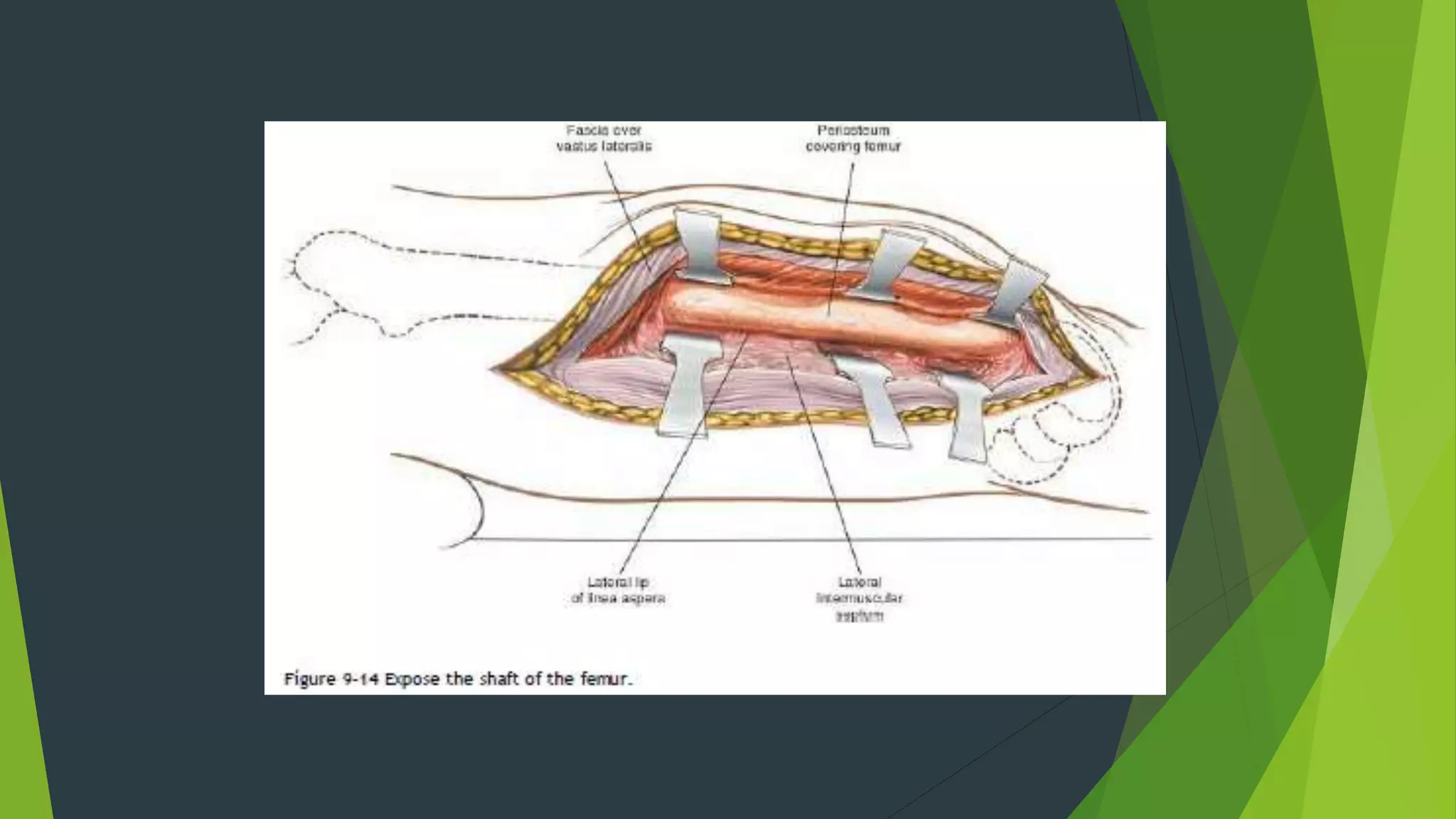 Pendekatan dan Plating untuk Fraktur Poros Femoralis.pptx