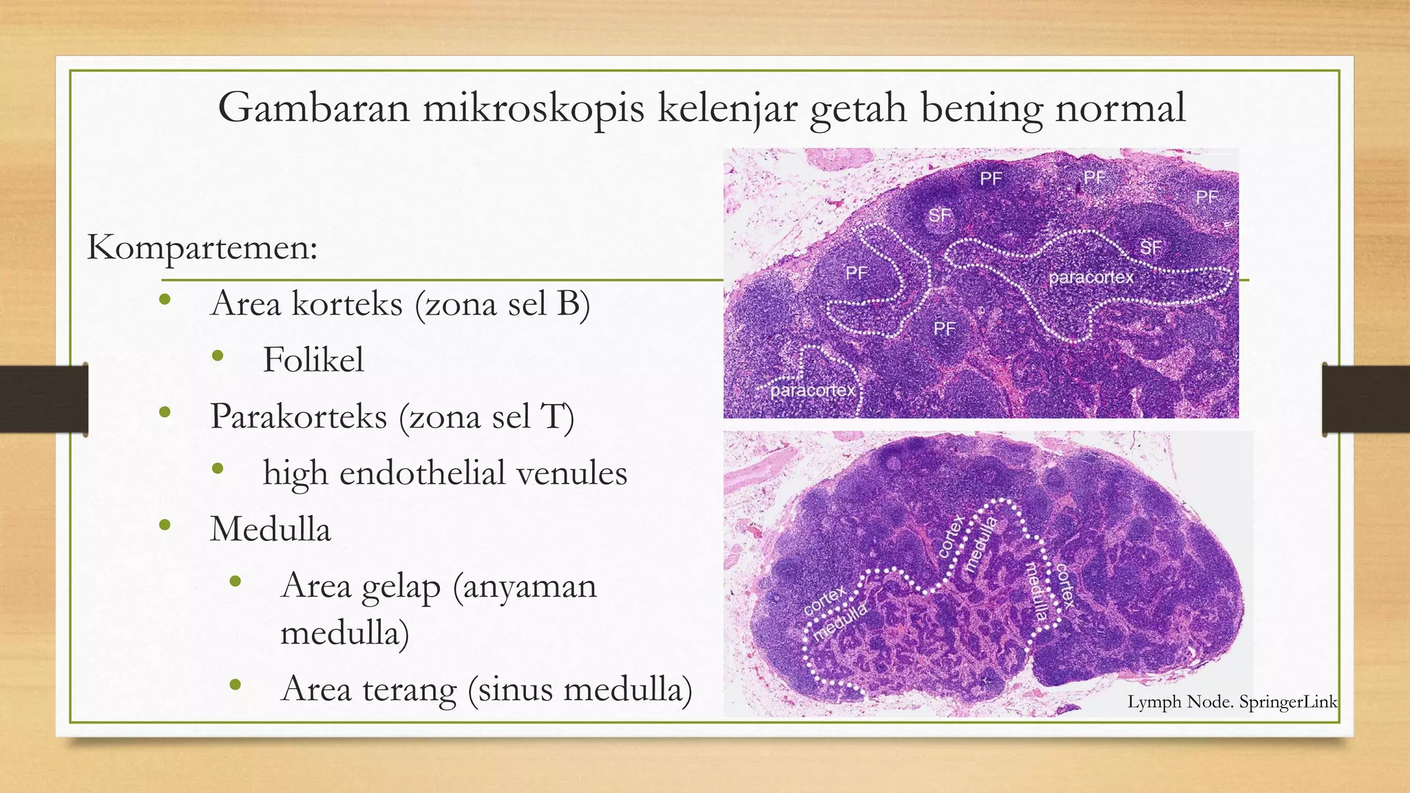 Pendekatan Pola Histopatologi dalam Diagnosis Limfadenopati kelompok B.pdf