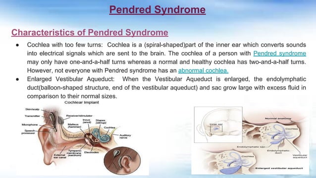 Pendred syndrome causing hearing loss.