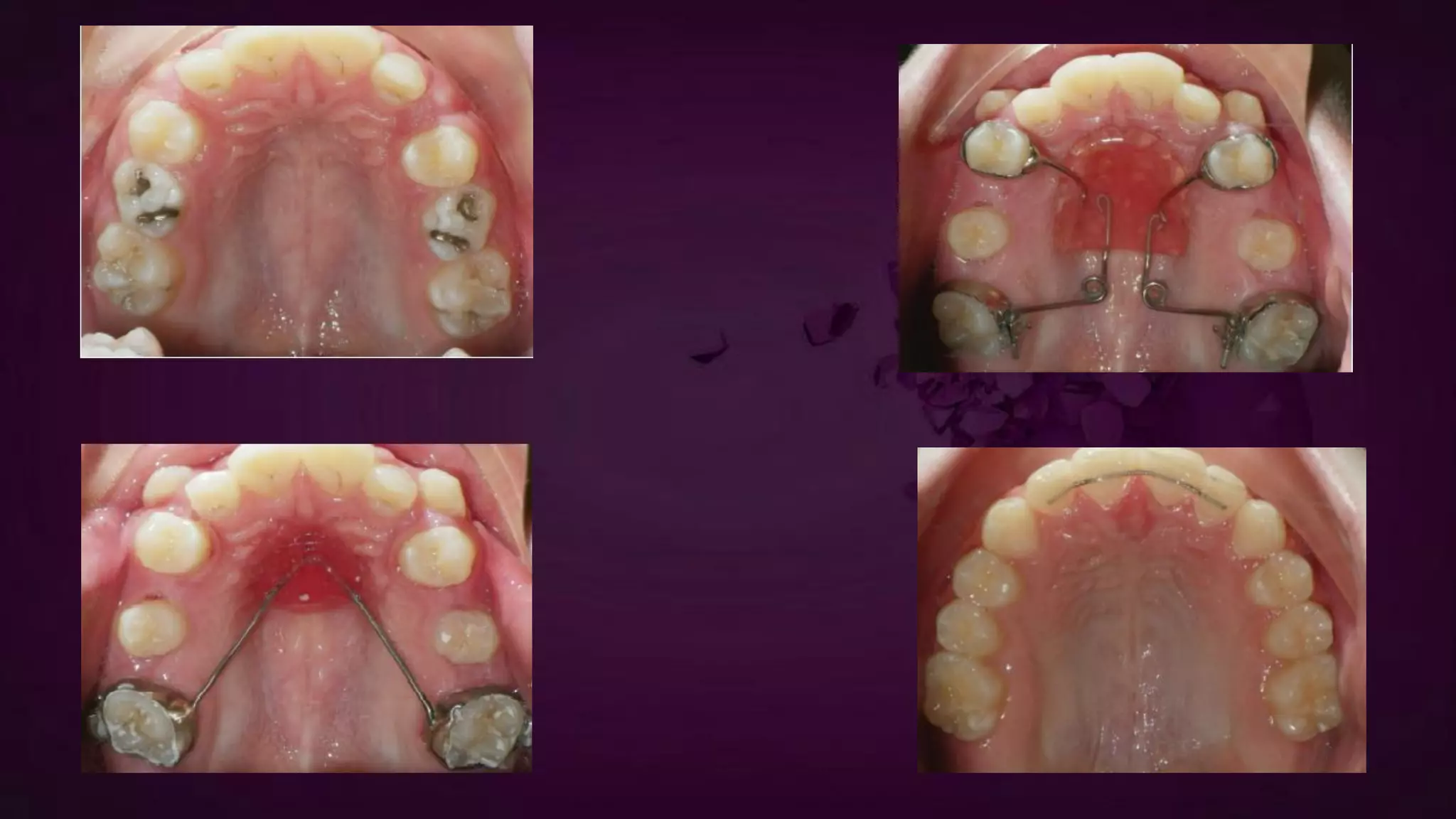 PENDULUM APPLIANCE.pdf