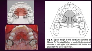 PENDULUM APPLIANCE.pdf