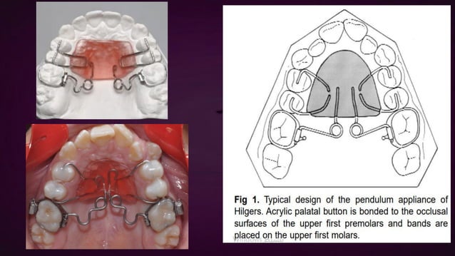 PENDULUM APPLIANCE.pdf