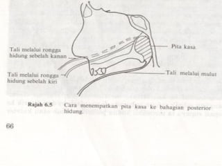 PENEMBUSAN GEGENDANG TELINGA | PPT