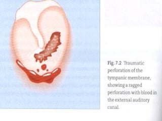 PENEMBUSAN GEGENDANG TELINGA | PPT