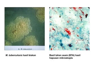 Penemuan Pasien TB FASILITAS KESEHATAN TINGKAT LANJUT | PPTX