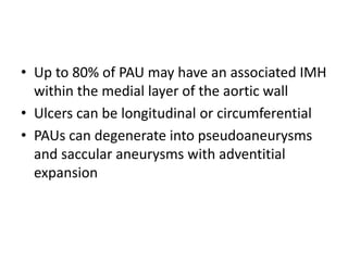 Penetrating aortic ulcer | PPTX