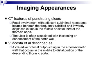 Penetrating Atherosclerotic Ulcer | PPT
