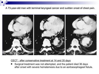 Penetrating Atherosclerotic Ulcer | PPT