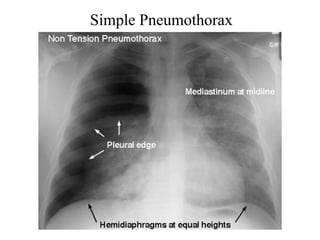Penetrating chest trauma it's prognosis and management | PPT