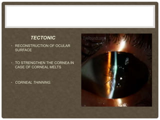 Penetrating keratoplasty | PPTX