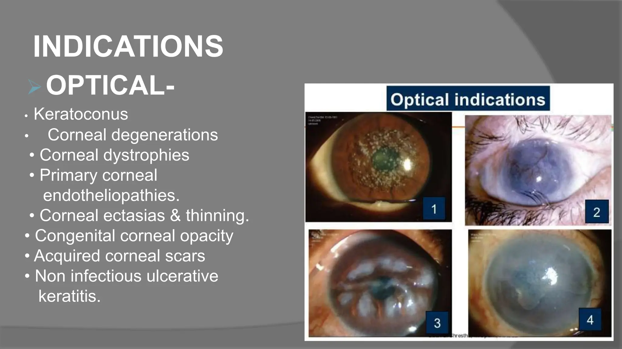 penetrating keratoplasty seminar ...pptx
