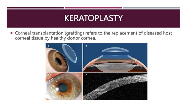PENETRATING KERATOPLASTY SEMINAR new.pptx | Eye and Vision Conditions ...