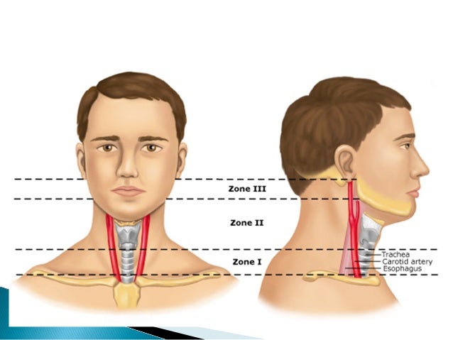 Penetrating neck injury