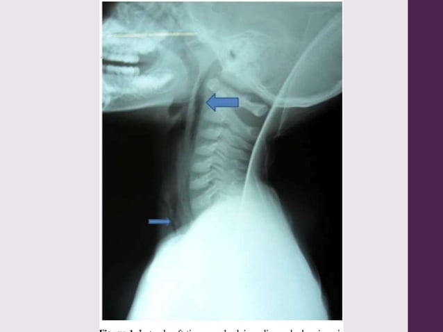 Penetrating neck trauma [autosaved] | PPTX
