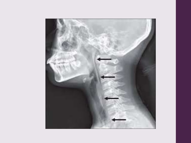 Penetrating neck trauma [autosaved] | PPTX