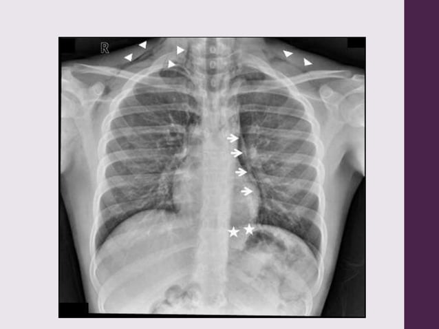Penetrating neck trauma [autosaved] | PPTX