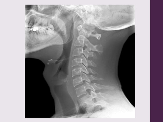 Penetrating neck trauma [autosaved] | PPTX