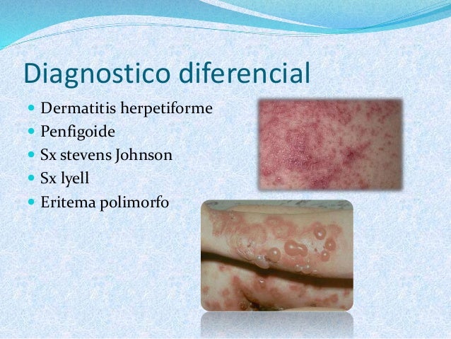 Penfigo y Penfigoides