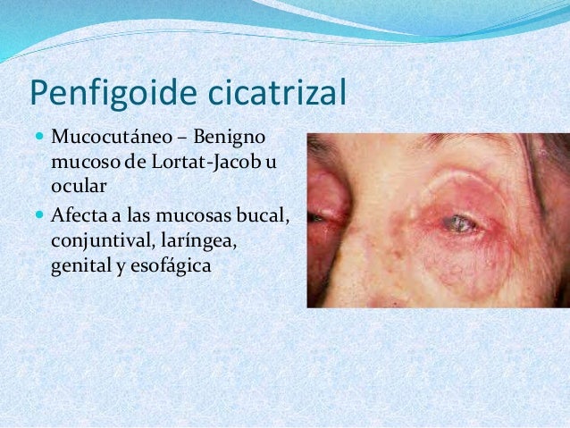 Penfigo y Penfigoides