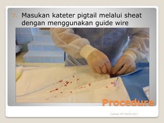 Pengelolaan pasien pungsi perikardium | PDF
