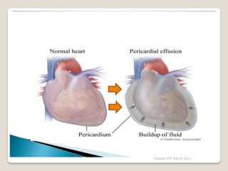 Pengelolaan pasien pungsi perikardium | PDF