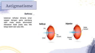 Penggunaan Refraksi Siklopegik pada kelainan refraksi anak ...