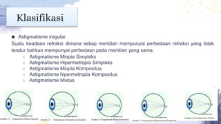 Penggunaan Refraksi Siklopegik pada kelainan refraksi anak ...