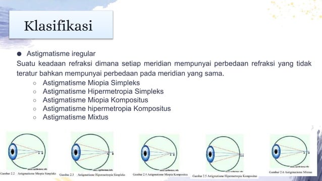 Penggunaan Refraksi Siklopegik pada kelainan refraksi anak (astigmatisme).pptx