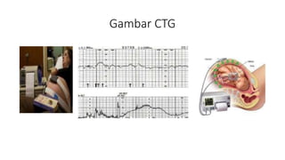 PENGGUNAAN TEKNOLOGI PADA KEHAMILAN KOMPLIKASI.pptx
